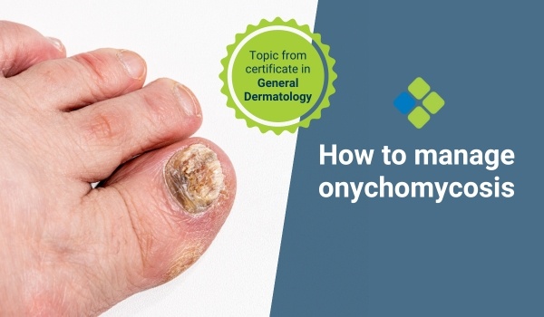 Onychomycosis treatment store